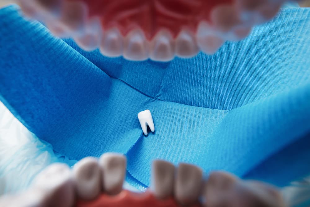 What to Do if Your Tooth Falls Out - Dental Brothers